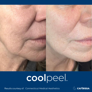 CoolPeel Laser Services in Sheridan, Buffalo and Gillette, WY ...